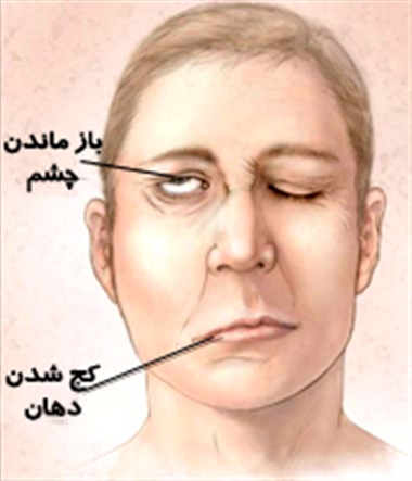 فلج صورت (فلج بلز) - درمان فلج صورت با دکتر الهه محقق منتظری